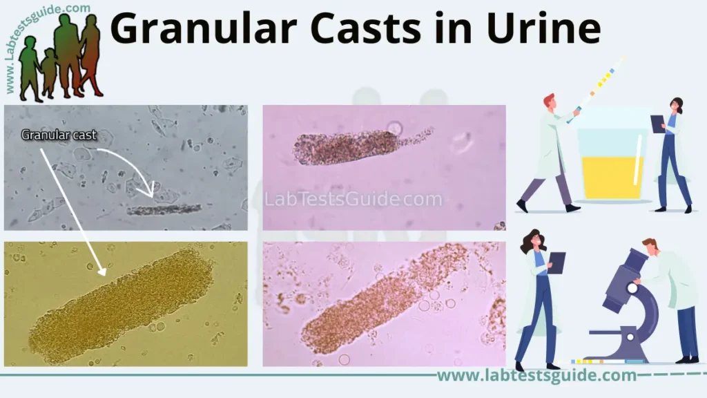 Granular Casts Definition Types Causes And Clinical Significance Granular Casts Definition Types Causes And Clinical Significance