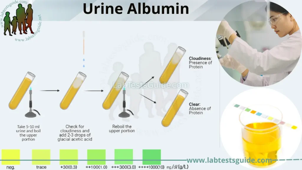 Urine Albumin Causes Symptoms Testing Results And Treatment